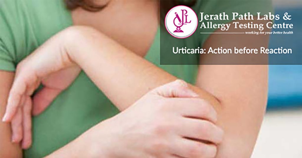 What is Urticaria Allergy? Test Required for Diagnosis and Treatment